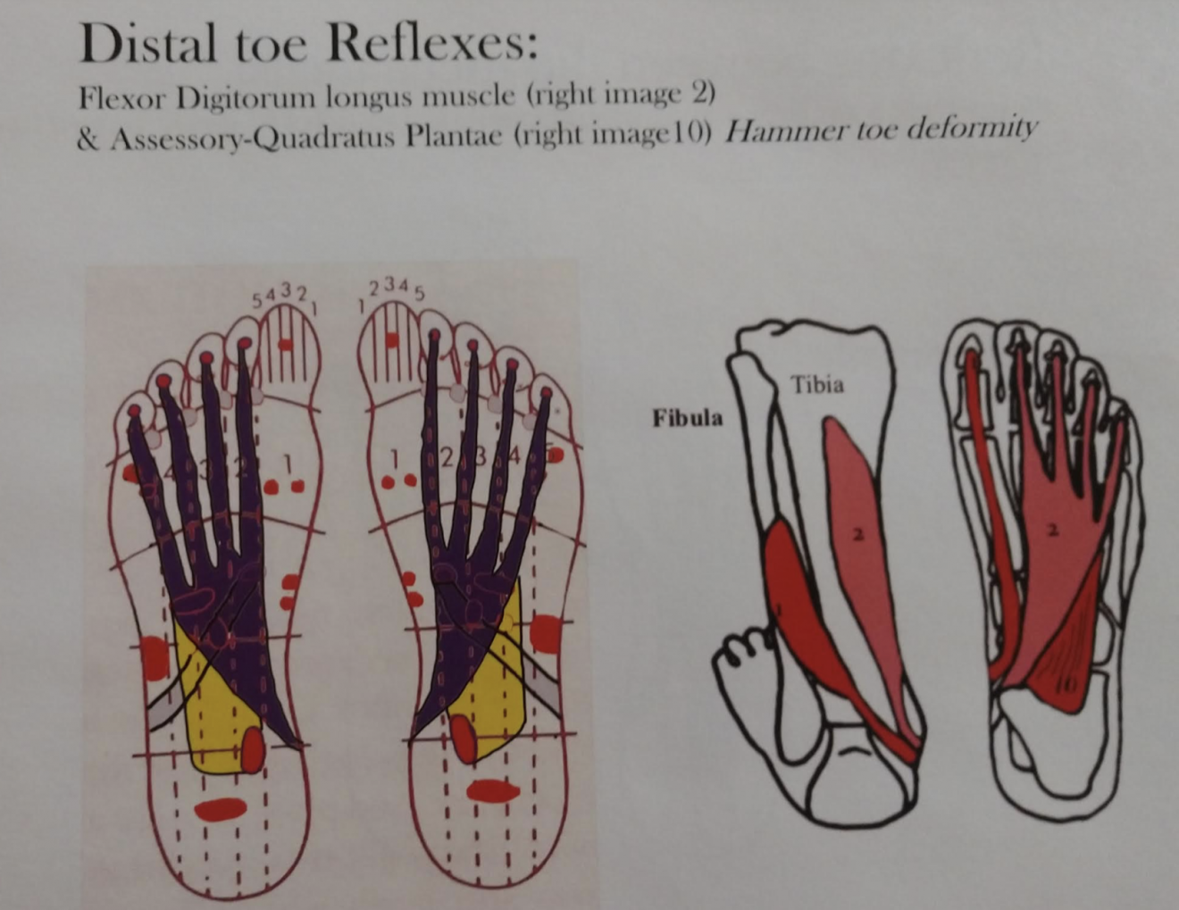 Understanding Hammer-Toes and How to Unbind Them « Put Your Best Feet ...